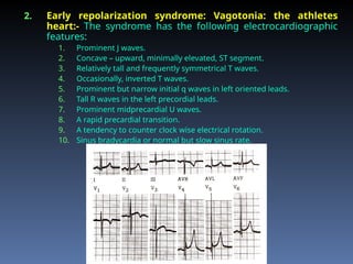 PPt on Normal ECG & P Wave with Normal ECG & P Wave.ppt