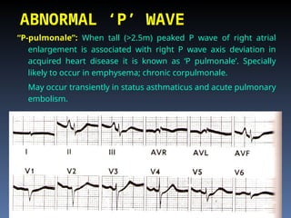 PPt on Normal ECG & P Wave with Normal ECG & P Wave.ppt