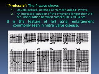 PPt on Normal ECG & P Wave with Normal ECG & P Wave.ppt