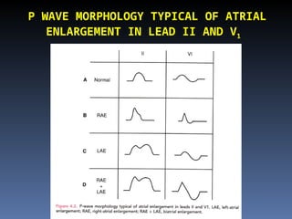 PPt on Normal ECG & P Wave with Normal ECG & P Wave.ppt
