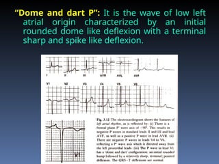 PPt on Normal ECG & P Wave with Normal ECG & P Wave.ppt