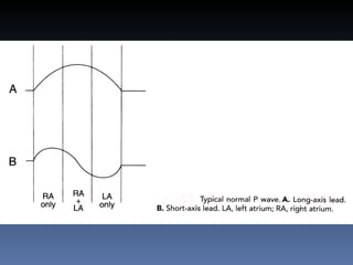 PPt on Normal ECG & P Wave with Normal ECG & P Wave.ppt
