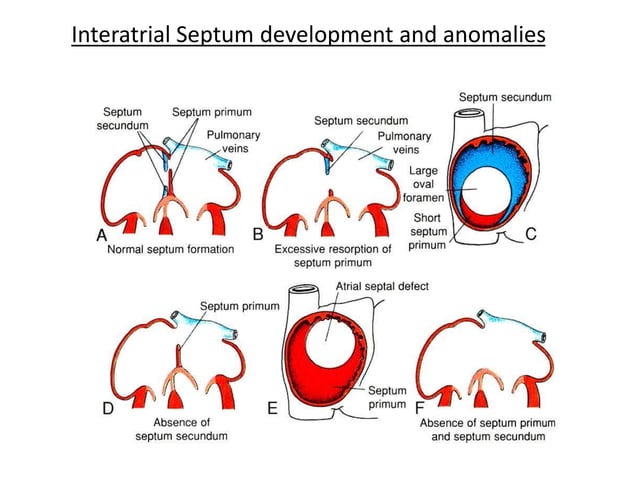 Right ATRIUM.pptx | Heart and Cardiovascular Diseases | Diseases and Conditions