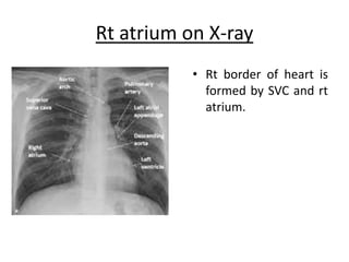 Right ATRIUM.pptx