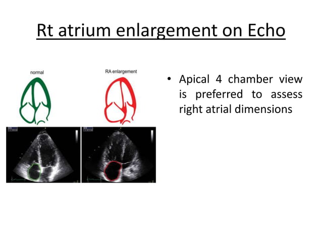 Right ATRIUM.pptx | Heart and Cardiovascular Diseases | Diseases and Conditions