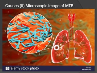 Presentation on tuberculosis-primarily a lung disease | PDF