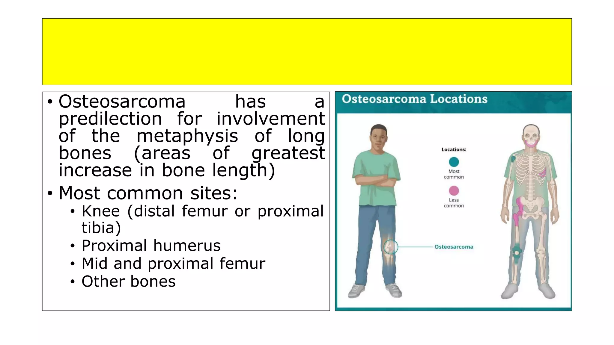 PPT osteosarcoma.pptx