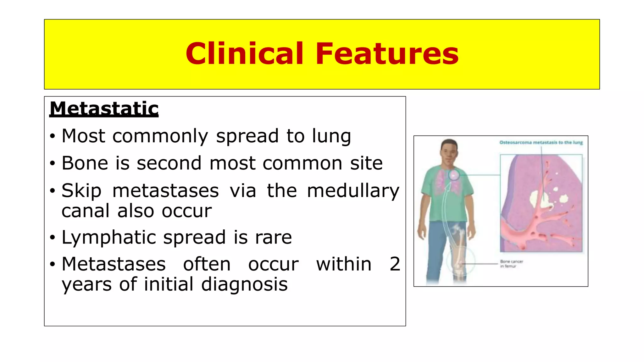 PPT osteosarcoma.pptx