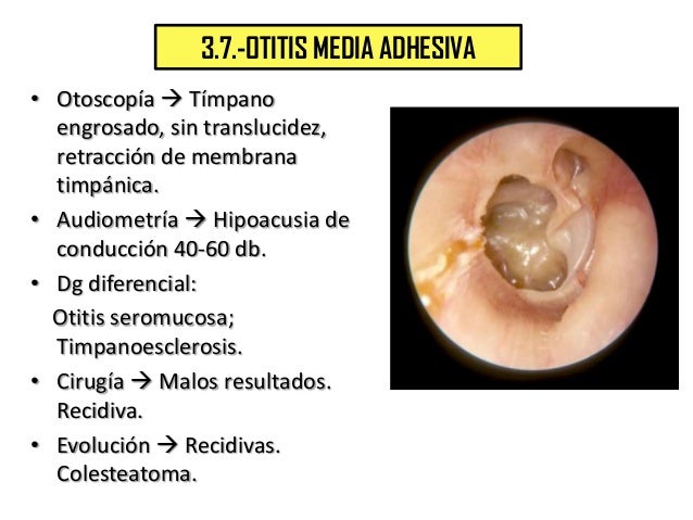 Otitis
