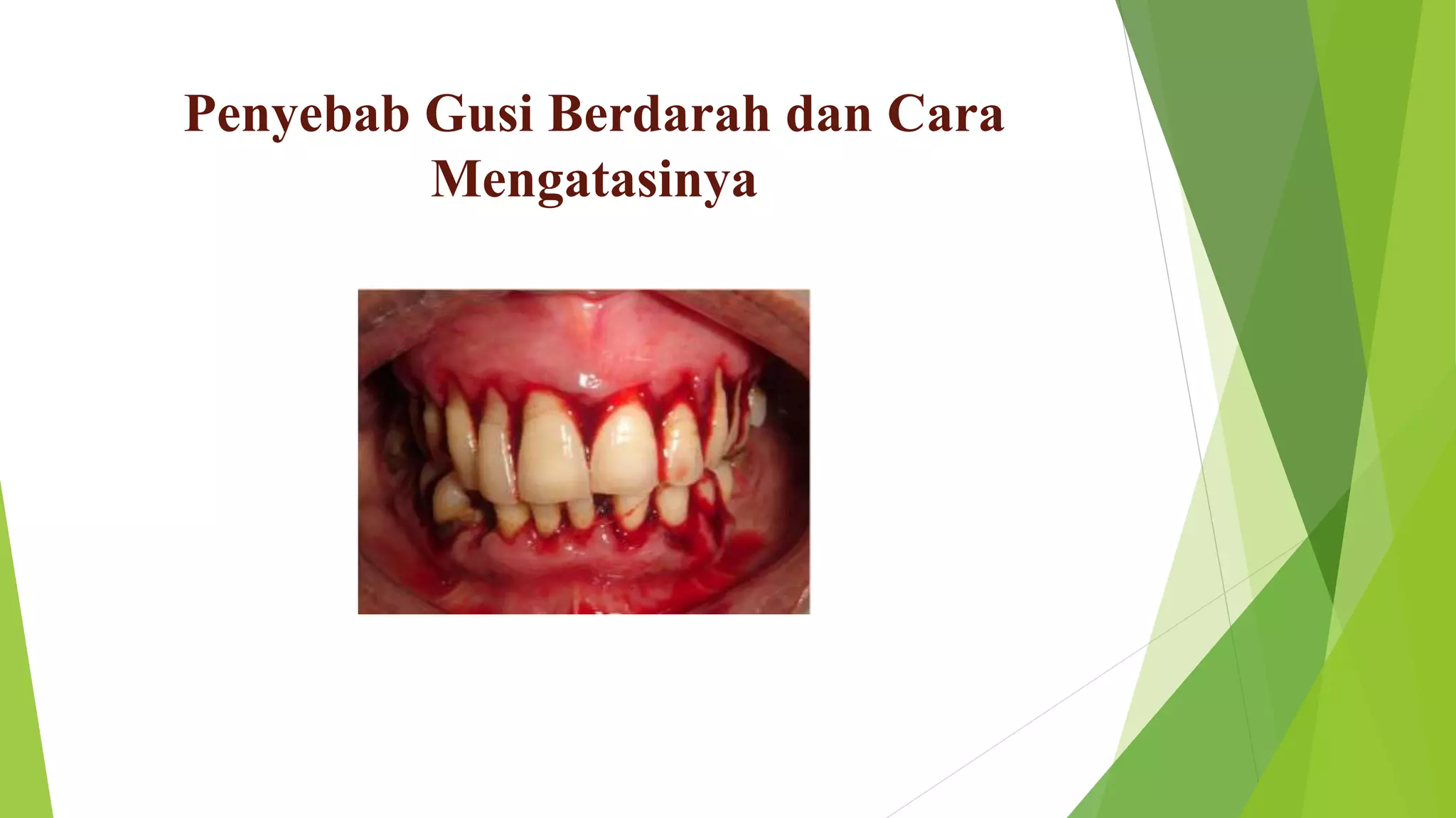 penyebab penyakit gusi berdarah pada mulut | PPTX