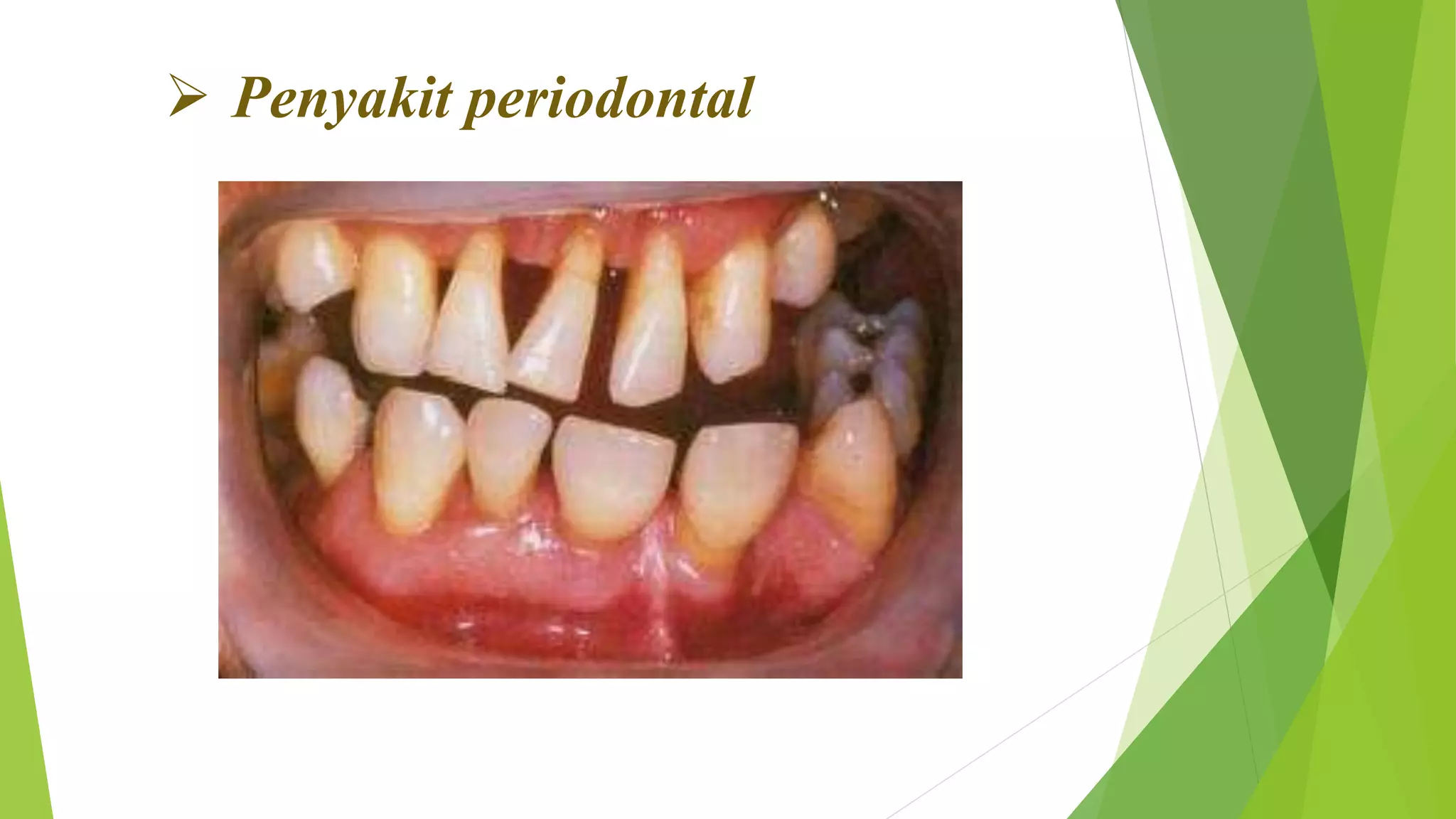 penyebab penyakit gusi berdarah pada mulut | PPTX