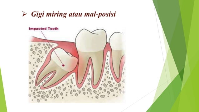 penyebab penyakit gusi berdarah pada mulut | PPT