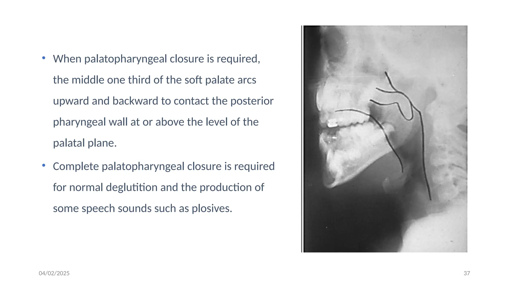 Presentation on palatopharyngeal prosthesis. | PPTX
