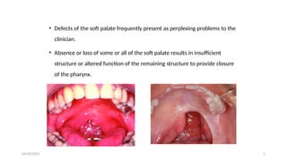 Presentation on palatopharyngeal prosthesis. | PPTX