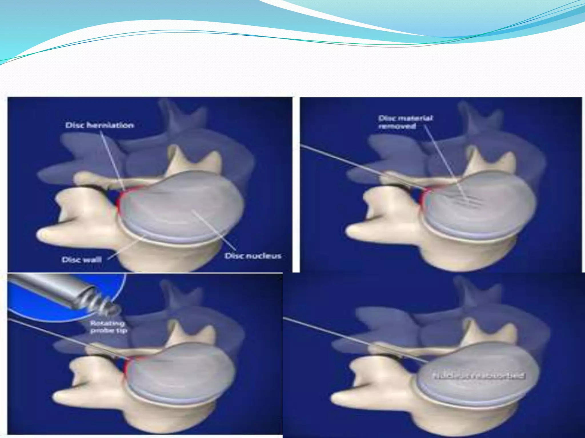Ppt paper presentation percutaneous discectomy | PPTX