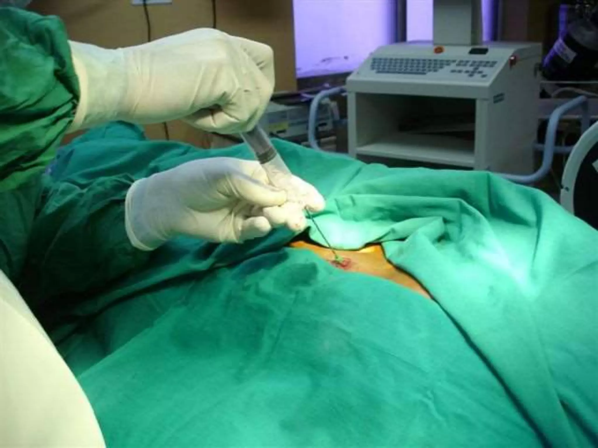 Ppt paper presentation percutaneous discectomy | PPT