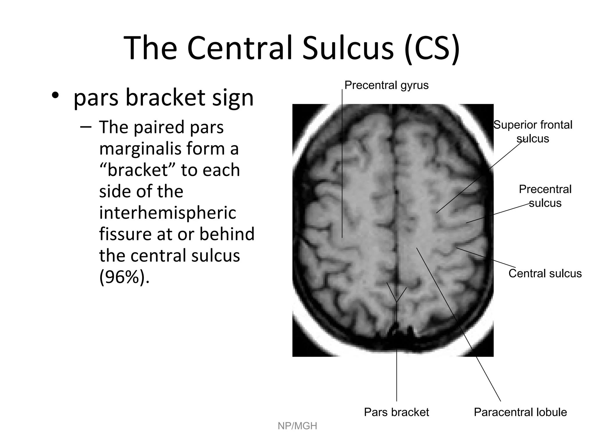 Ppt parietal lobe | PPT | Brain and Nervous System Disorders | Diseases ...