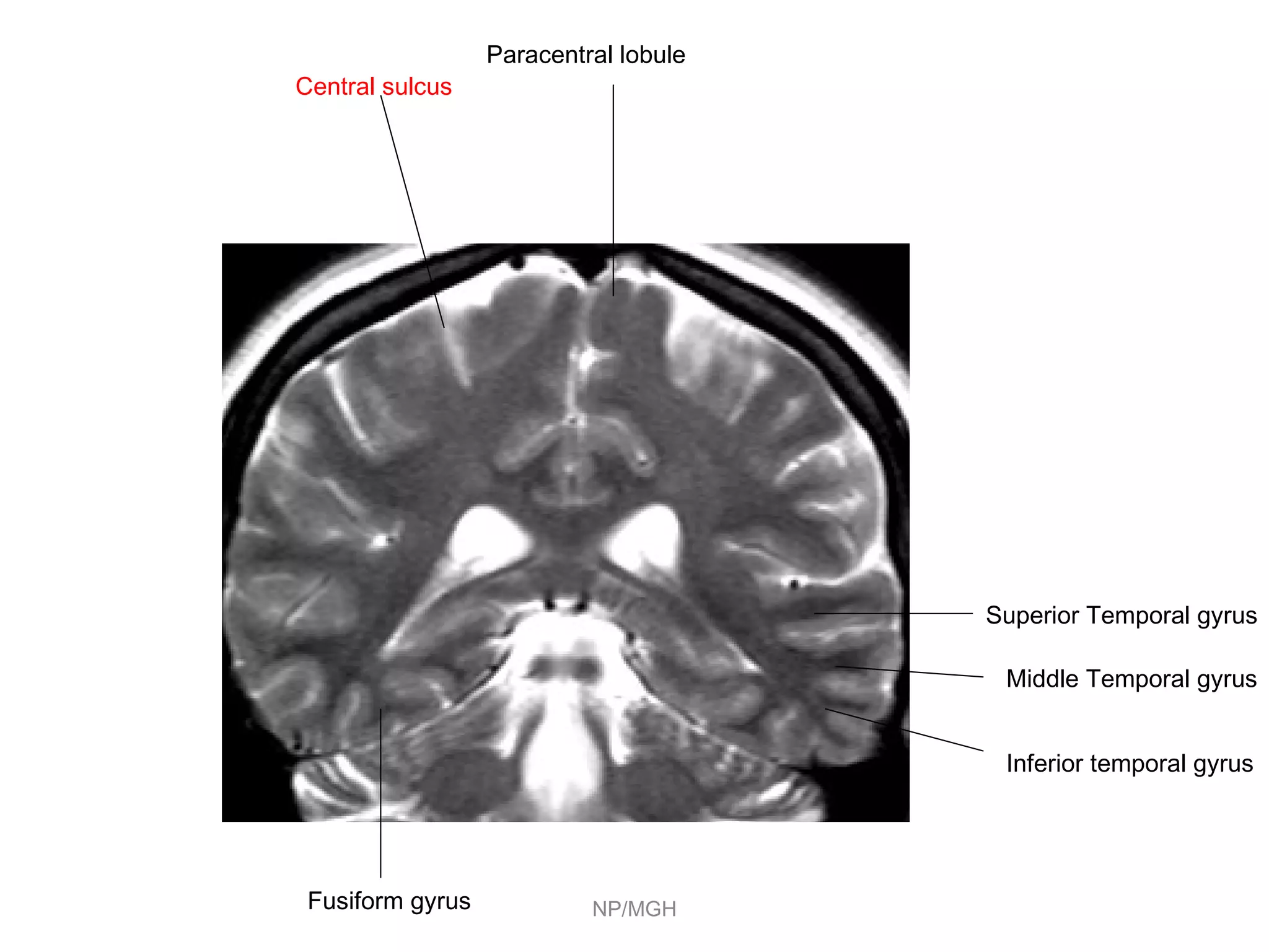 Ppt parietal lobe | PPT