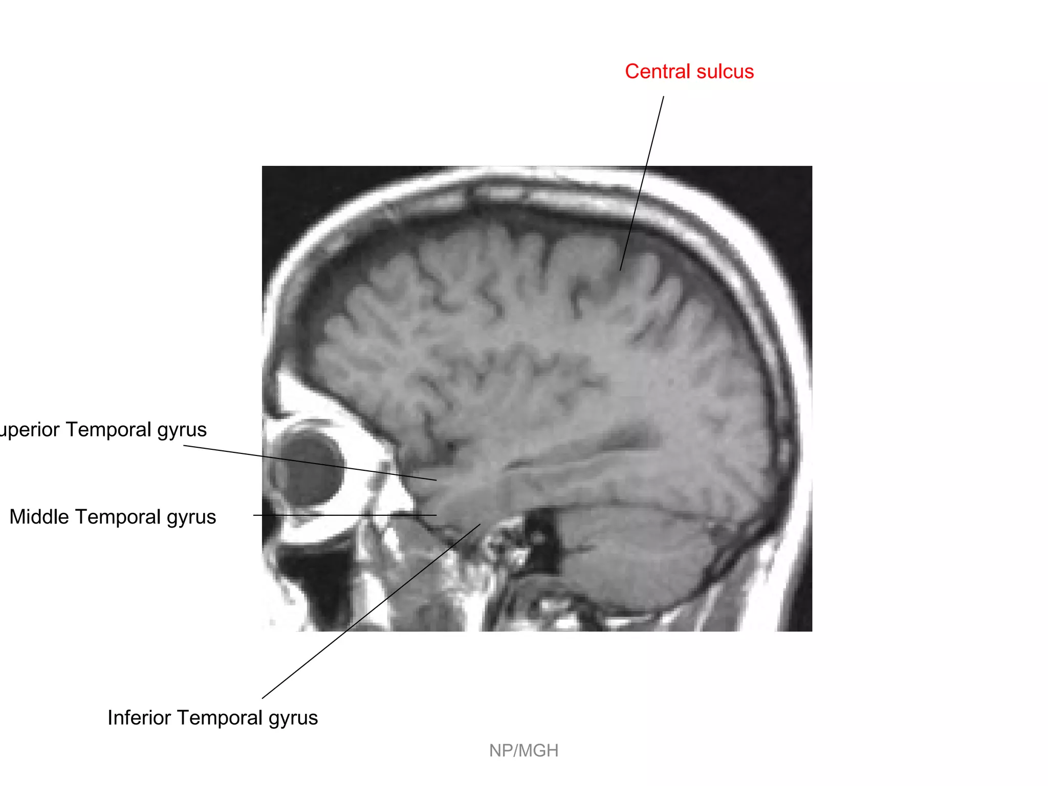 Ppt parietal lobe | PPT | Brain and Nervous System Disorders | Diseases ...