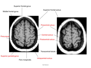 Ppt parietal lobe | PPT