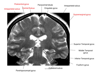 Ppt parietal lobe | PPT