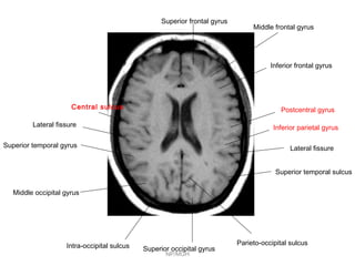 Superior Parietal Lobule Mri