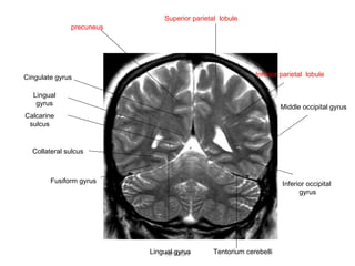 Superior Parietal Lobule Mri