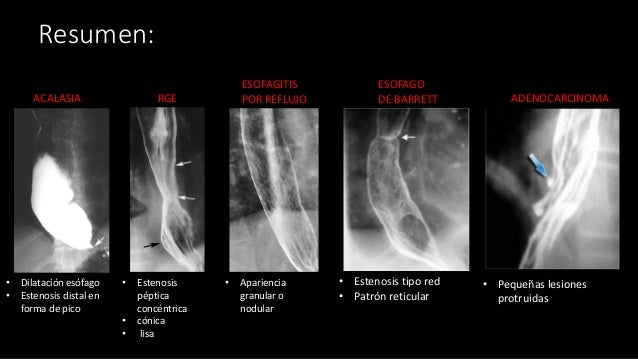 PPT PATOLOGÍAS PRINCIPALES DE ESÓFAGO