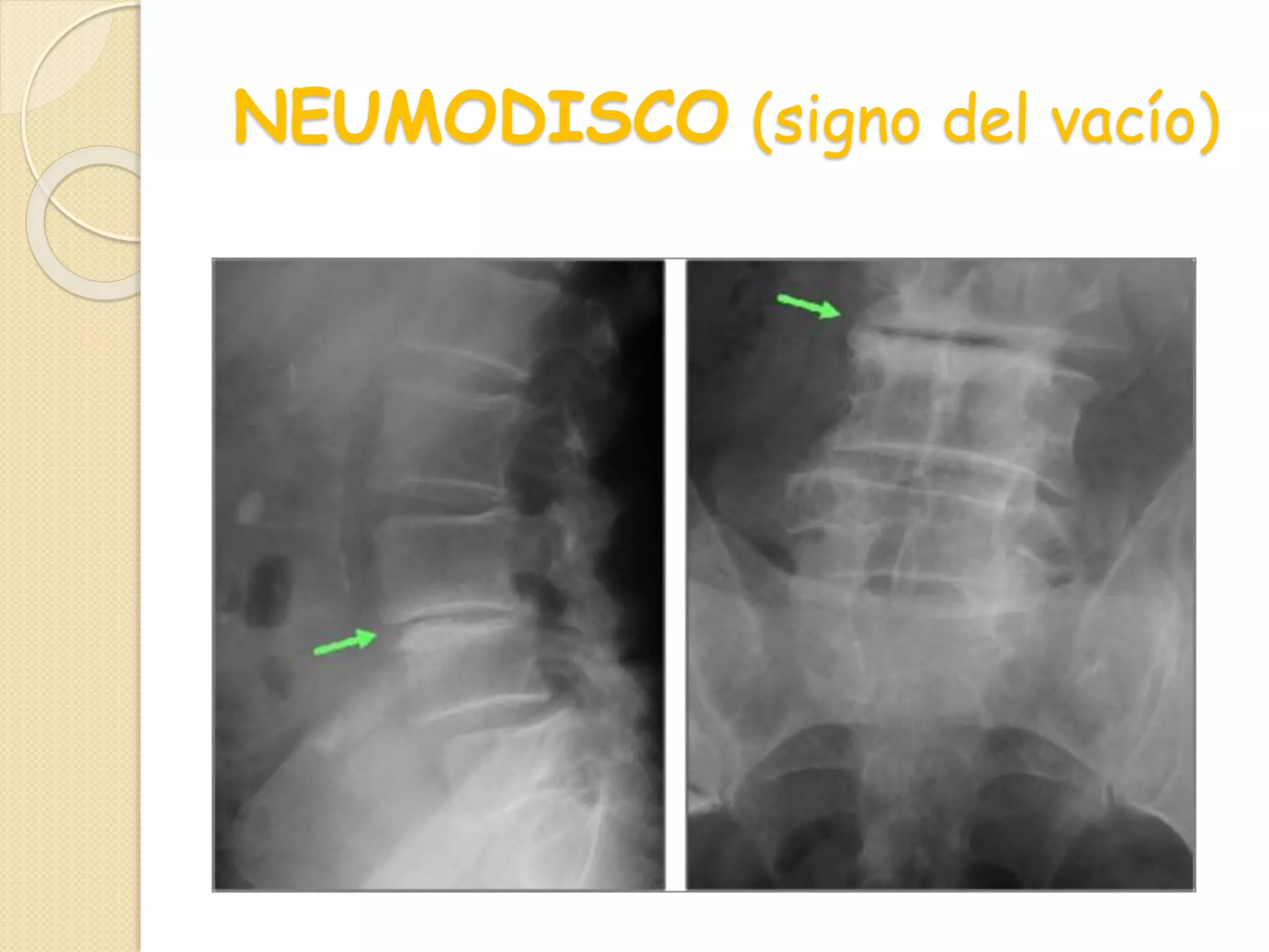 Ppt patologia radiologica de la columna vertebral y su contenido | PDF ...