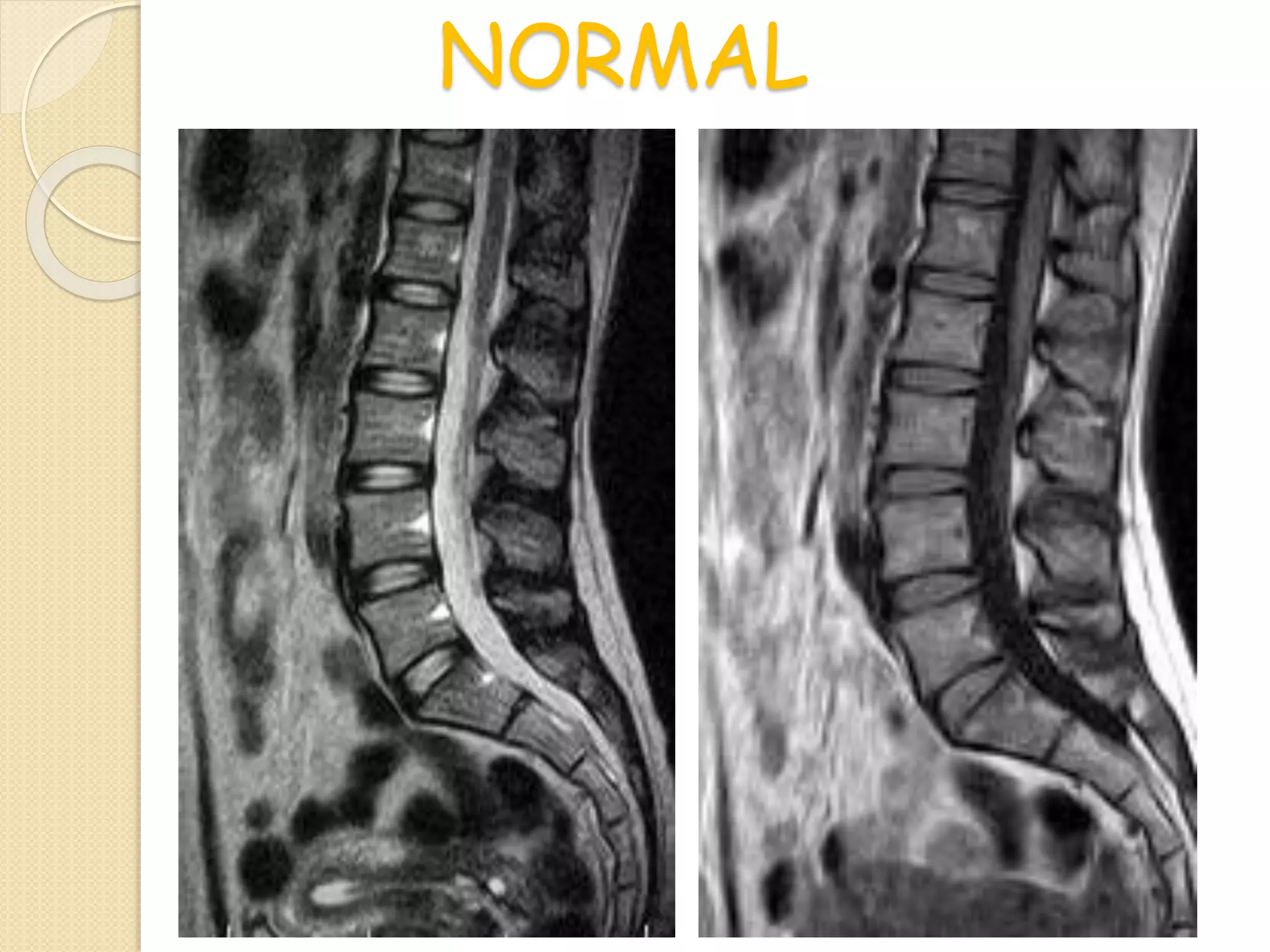 Ppt patologia radiologica de la columna vertebral y su contenido | PDF ...