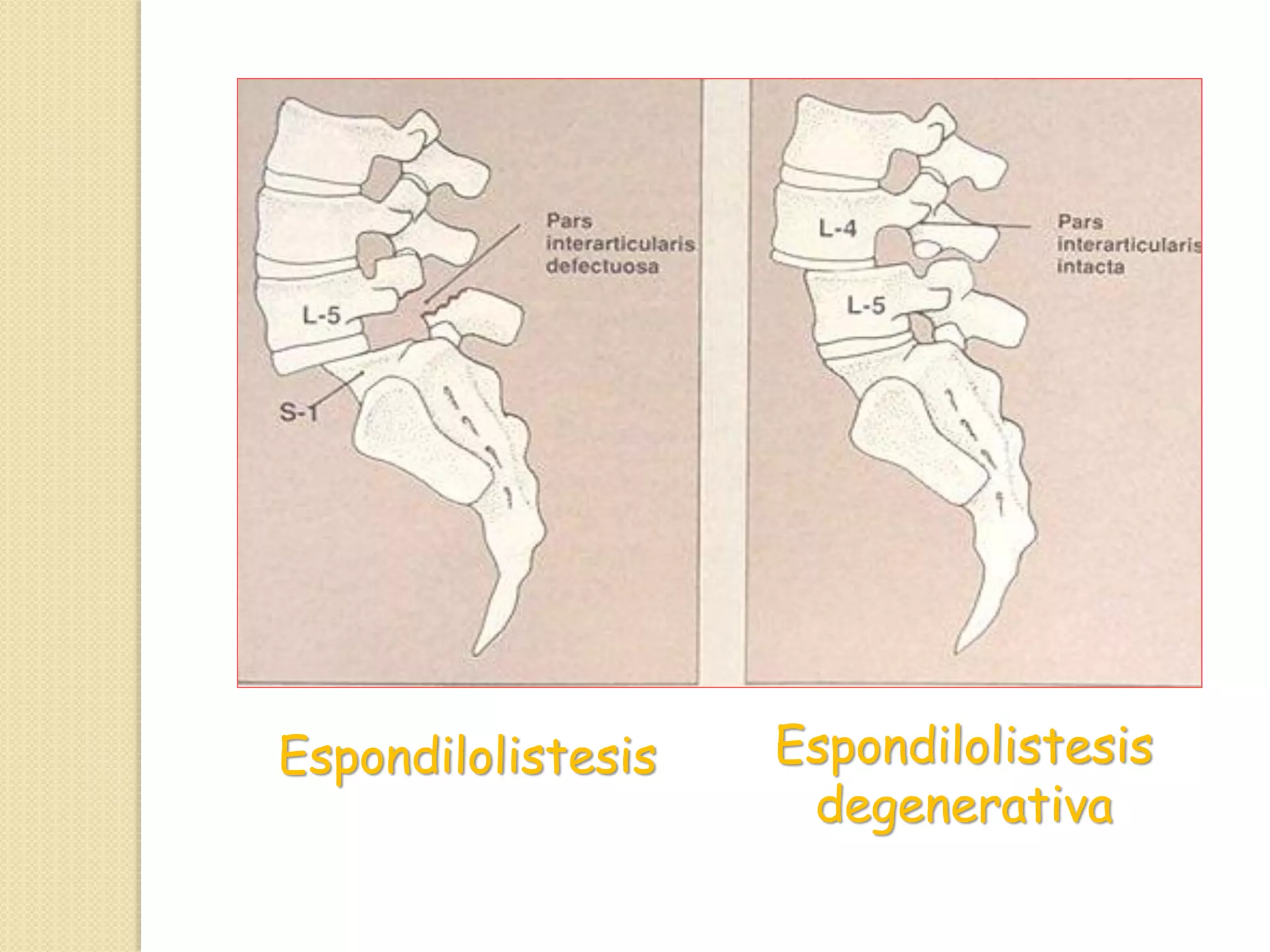 Ppt patologia radiologica de la columna vertebral y su contenido | PDF ...
