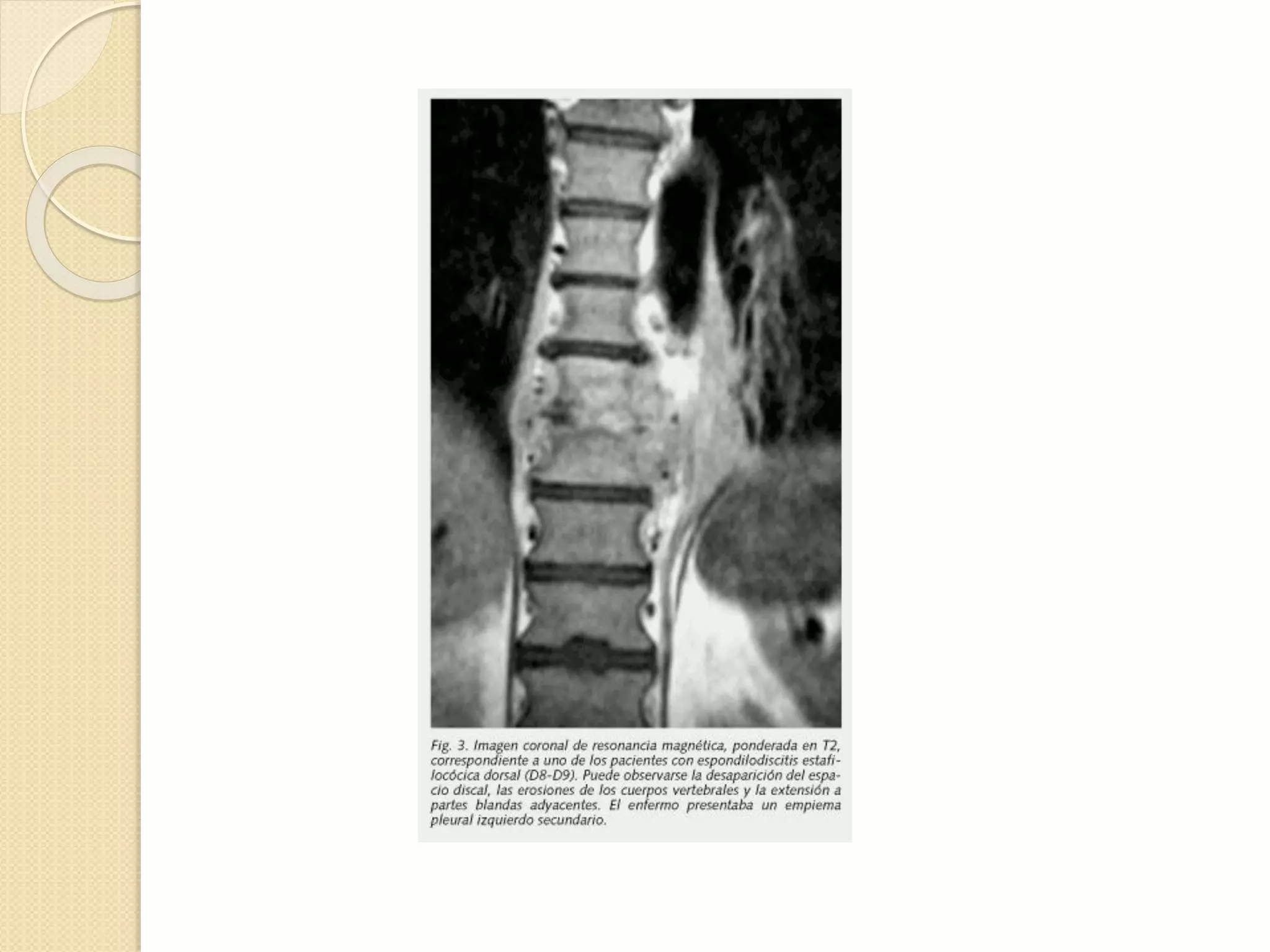 Ppt patologia radiologica de la columna vertebral y su contenido | PDF ...