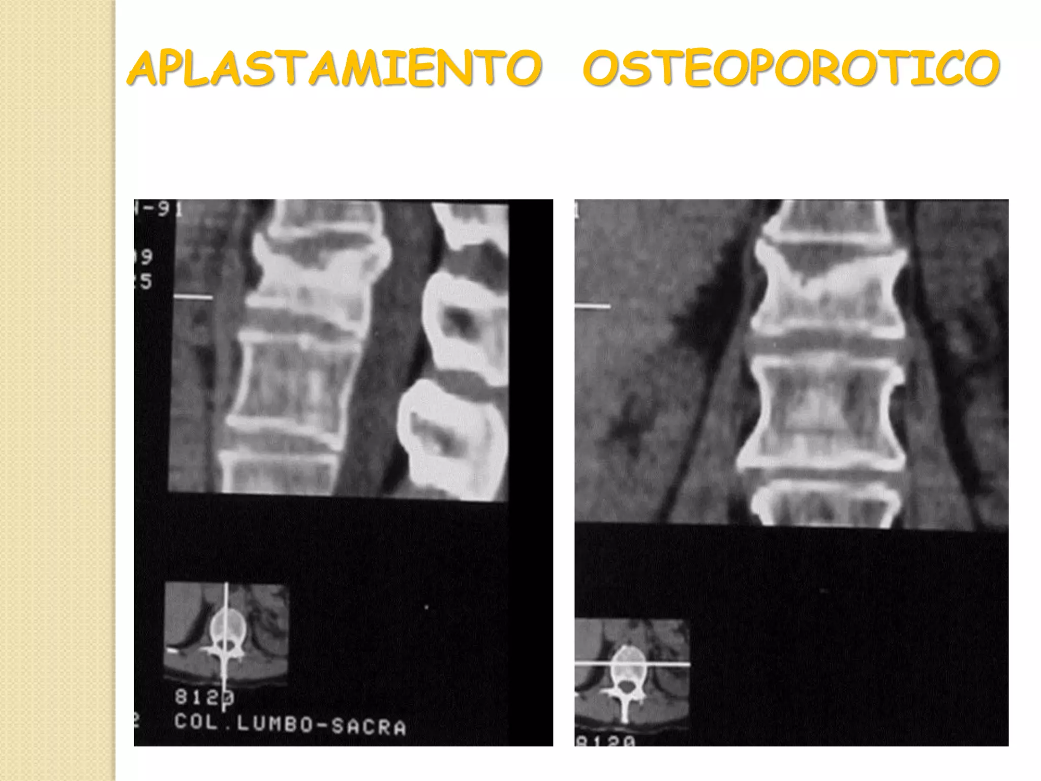 Ppt patologia radiologica de la columna vertebral y su contenido | PDF ...