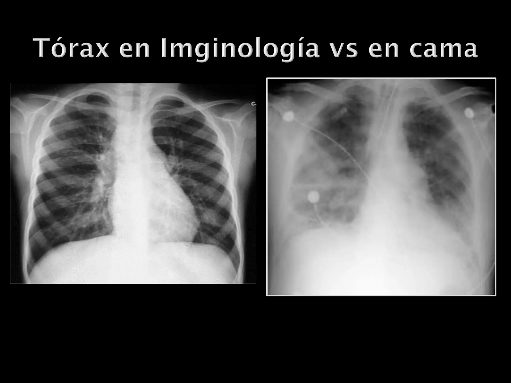 Ppt patologia radiologica del torax | PDF