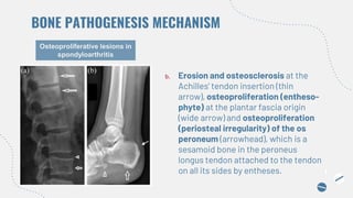 ABNORMALITAS TULANG PADA SPONDYLOARTHRITIS.pptx