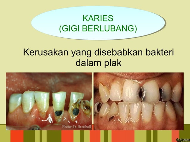 Ppt penyuluhan karang gigi karies | PPT