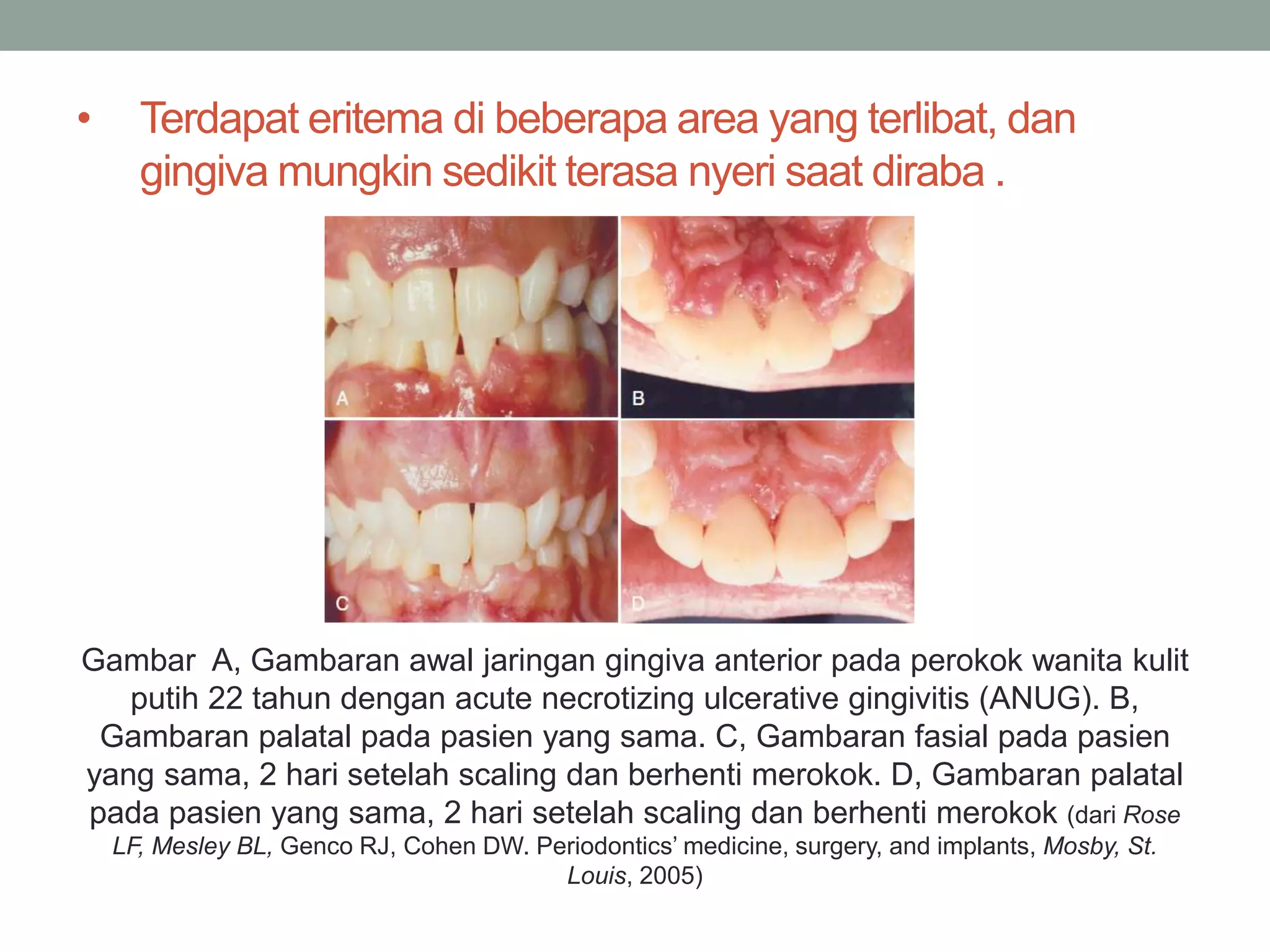 perawatan penyakit gingiva akut | PPTX