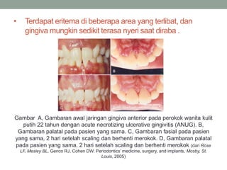 perawatan penyakit gingiva akut | PPTX