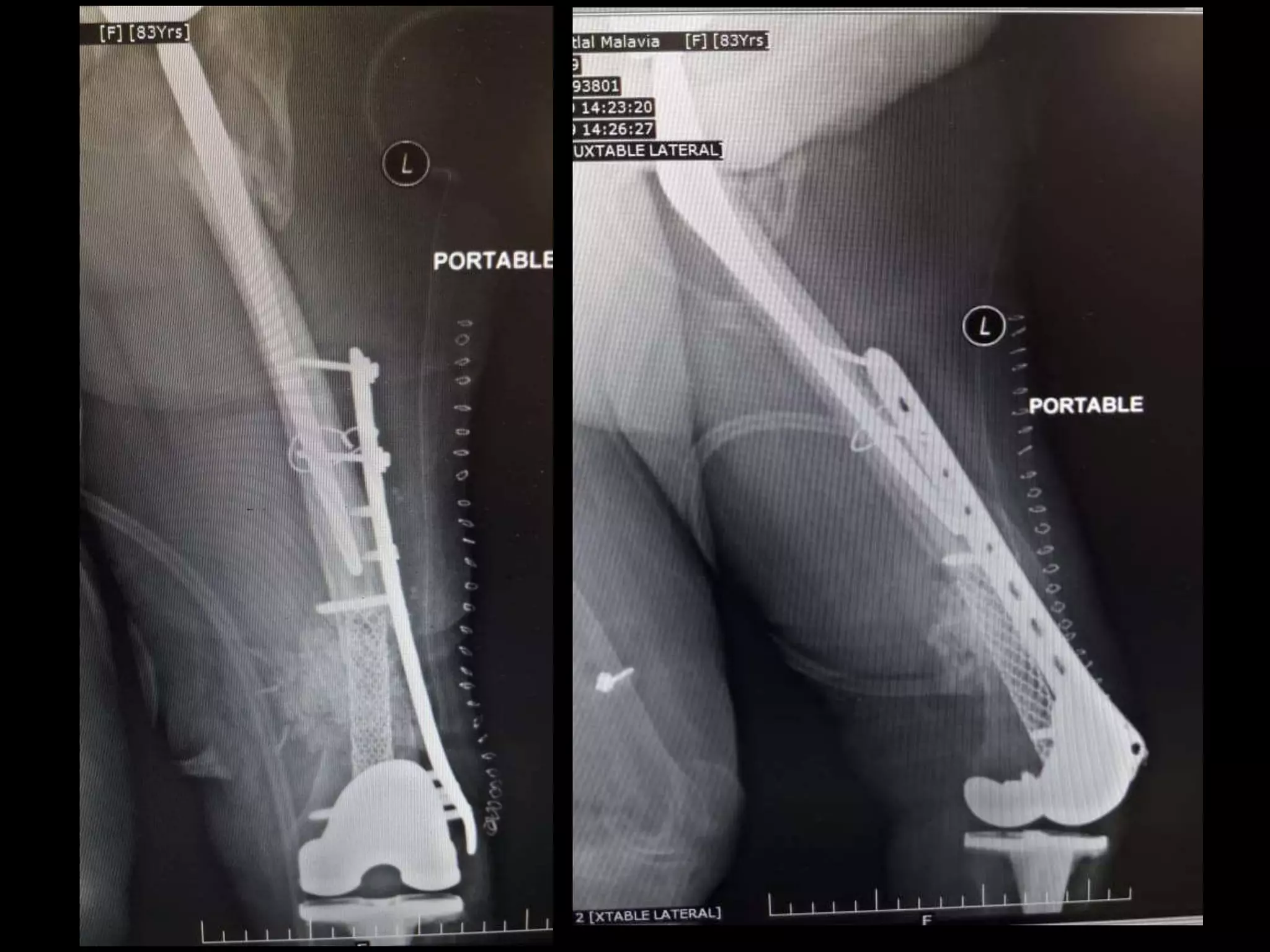 Periprosthetic Fractures around Knee | PPTX