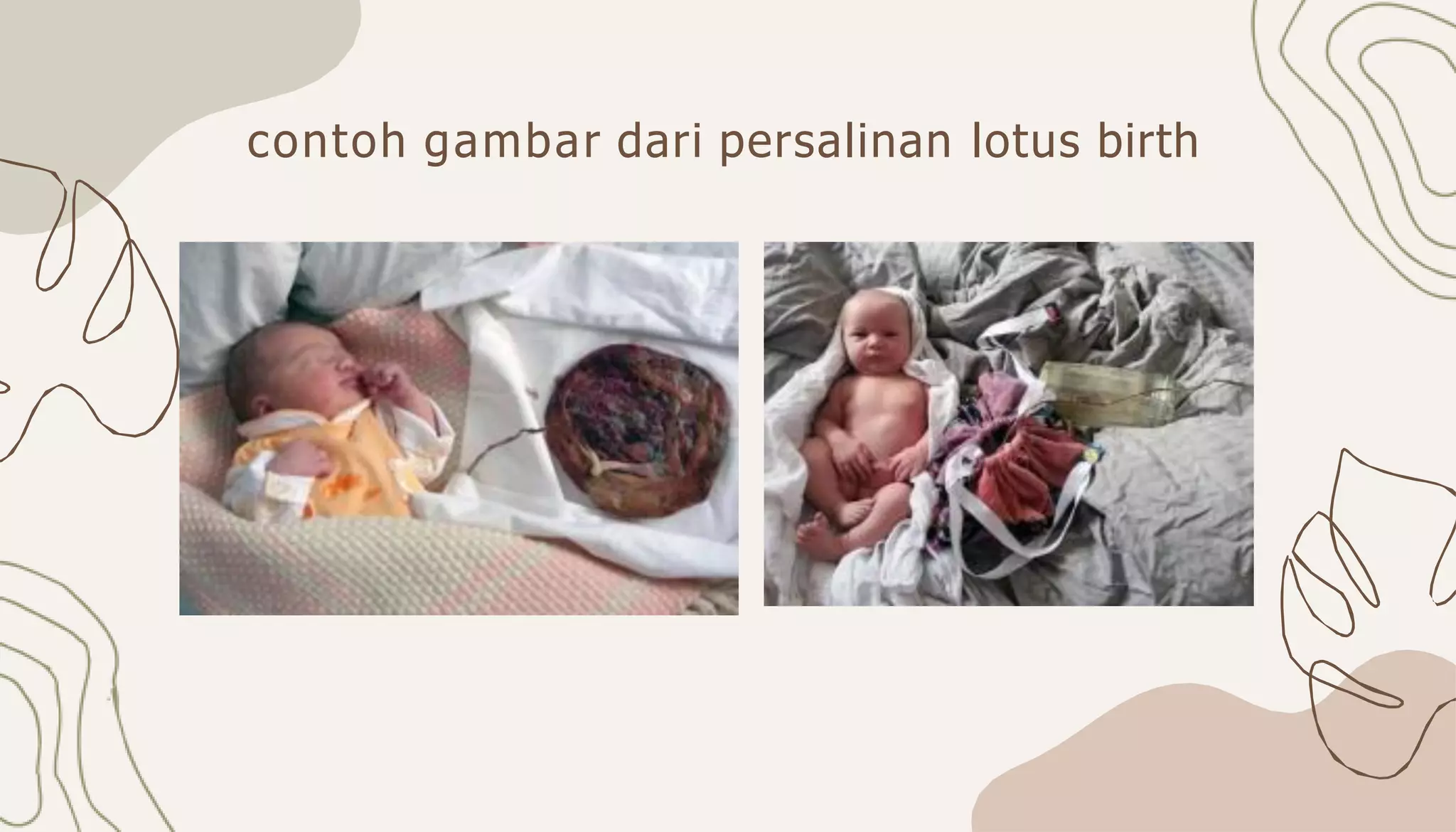 PPT Persalinan Lotus Birth PDF.pdf