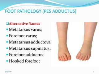 Ppt (pes adductus) | PPTX | Physical Therapy | Wellness