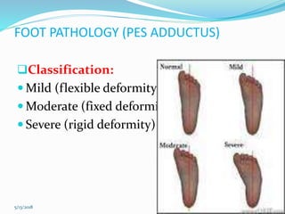 Ppt (pes adductus) | PPTX | Physical Therapy | Wellness
