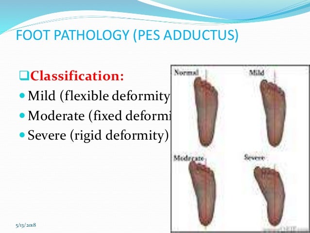 Ppt (pes adductus)