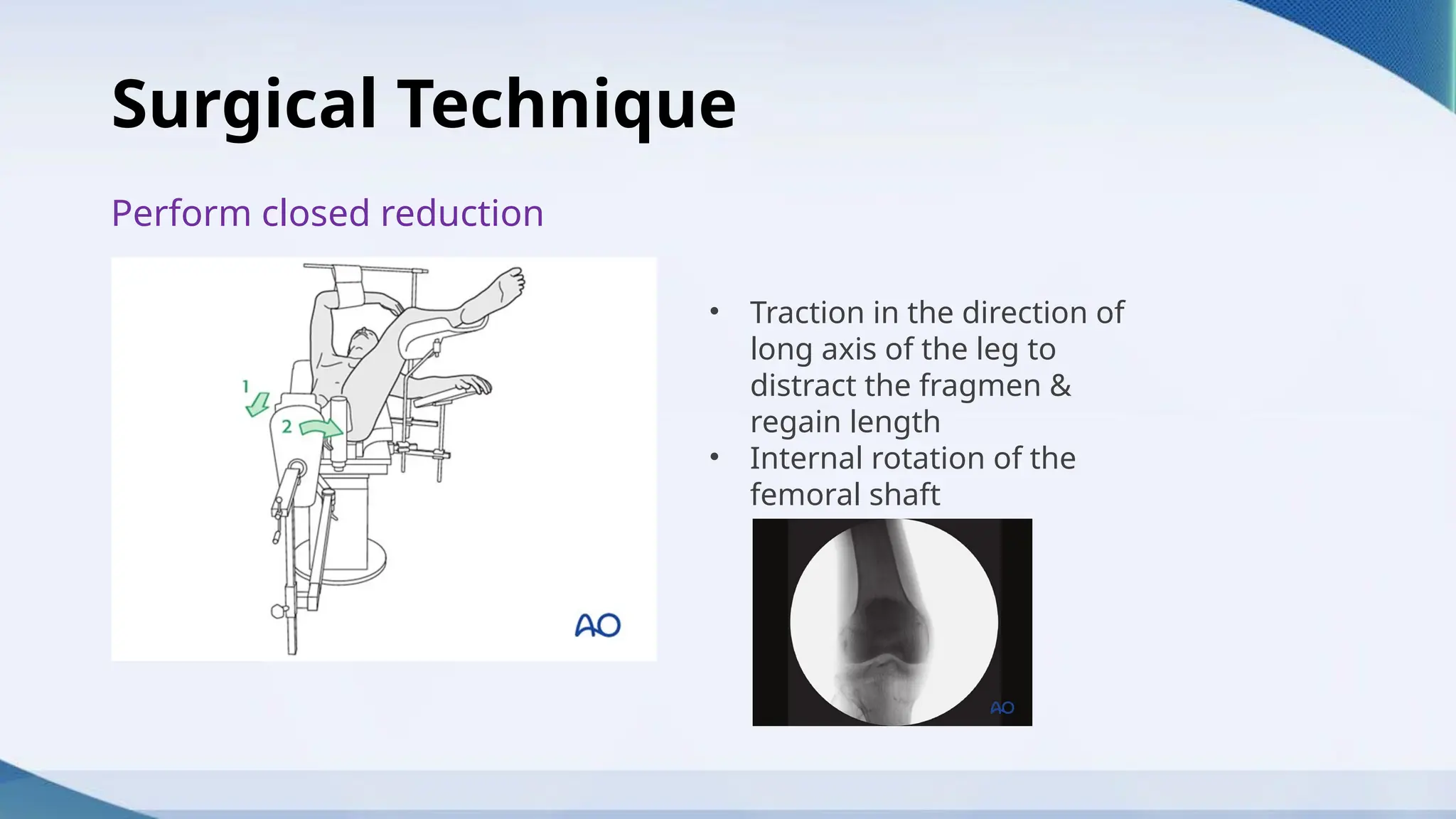 PPT Proximal Femoral Nail, Principles and Techniques | PPTX