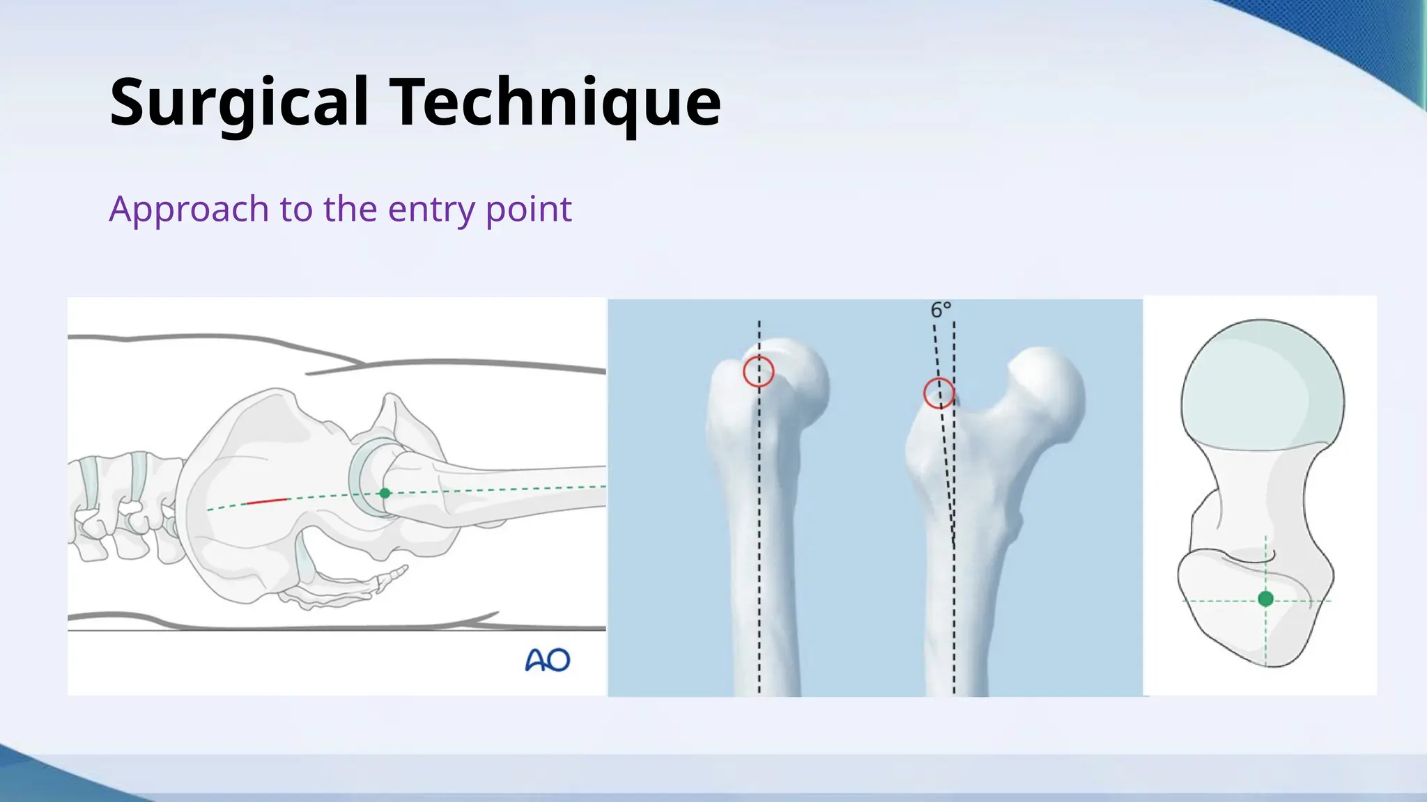 PPT Proximal Femoral Nail, Principles and Techniques | PPTX