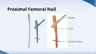 PPT Proximal Femoral Nail, Principles and Techniques | PPTX