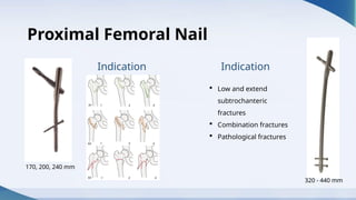 PPT Proximal Femoral Nail, Principles and Techniques | PPTX