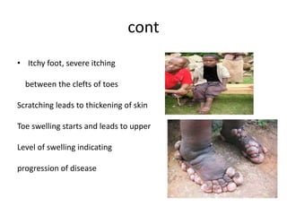 Podoconiosis, types and characteristics..pptx