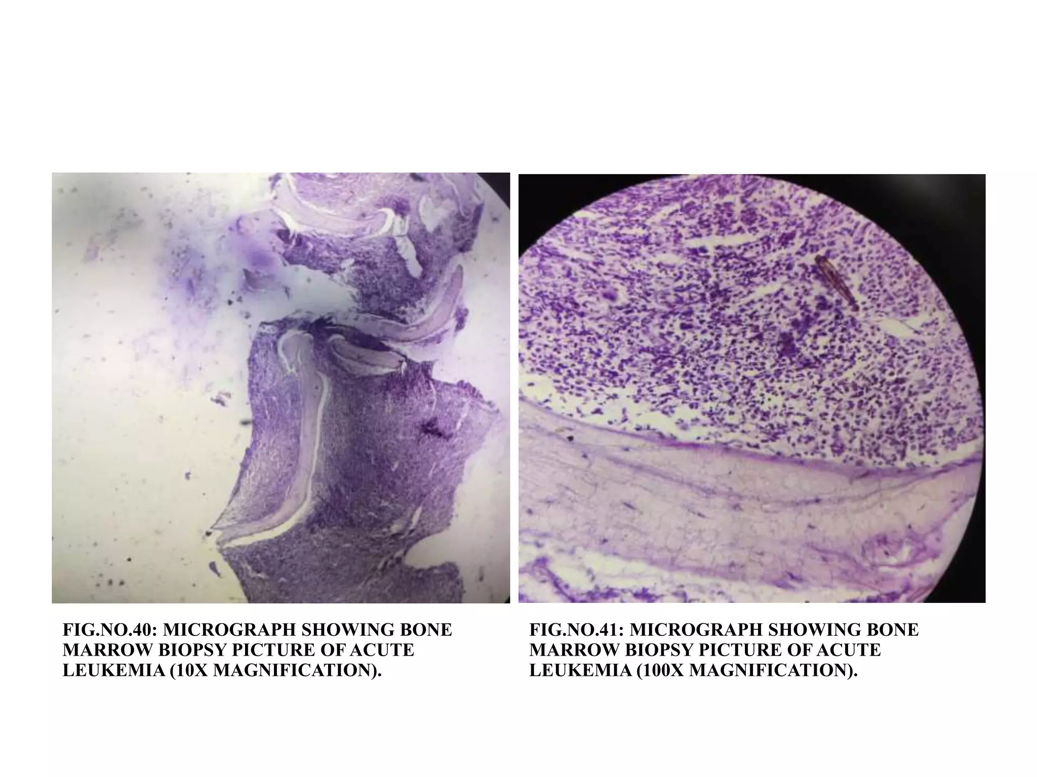 BONE MARROW BIOPSY PHOTOGRAPHS.pptx