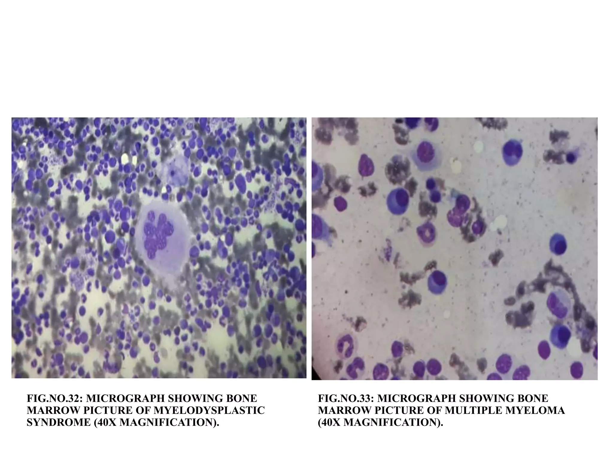 BONE MARROW BIOPSY PHOTOGRAPHS.pptx
